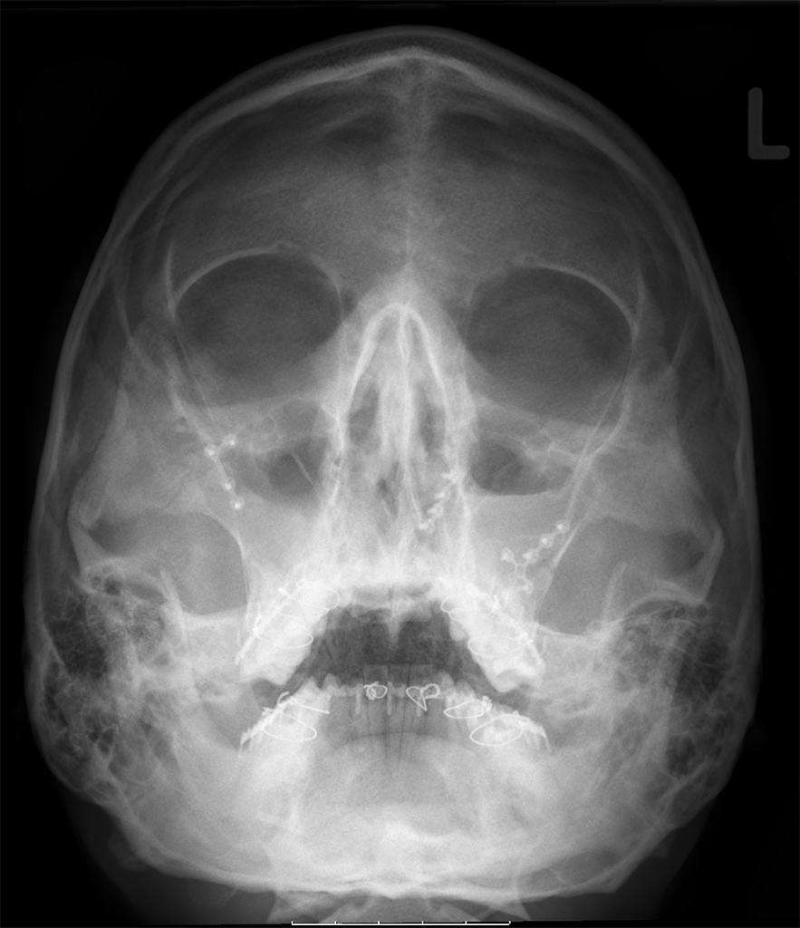 Schädel_Röntgen_final_s – Tobi und die Welt.